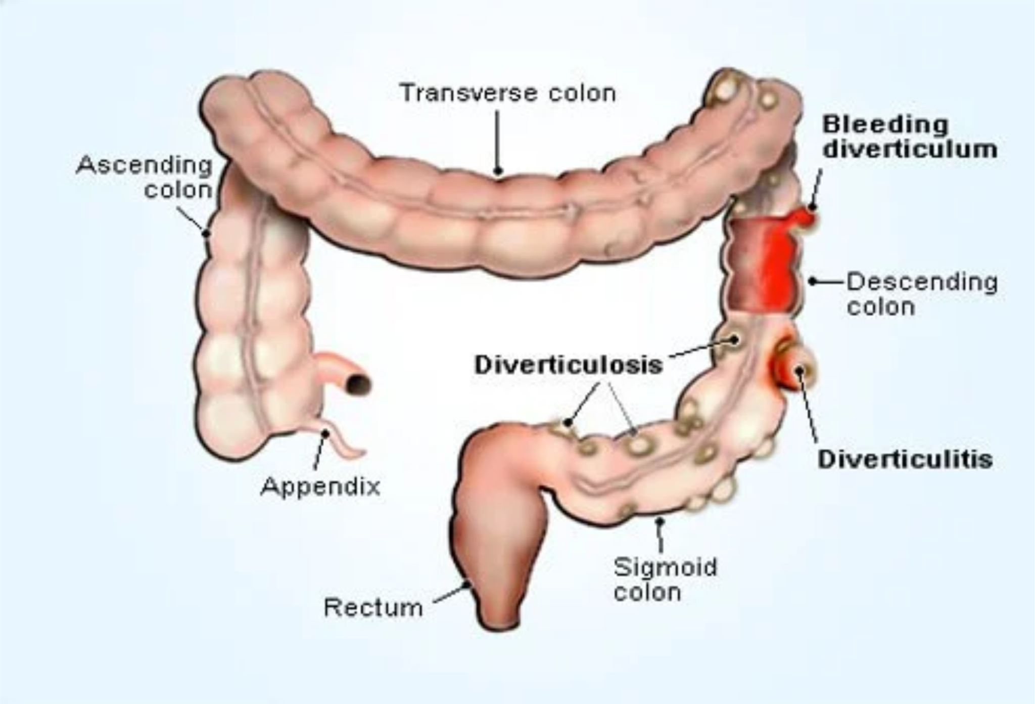 Diverticulitis – Exult Diagnostics
