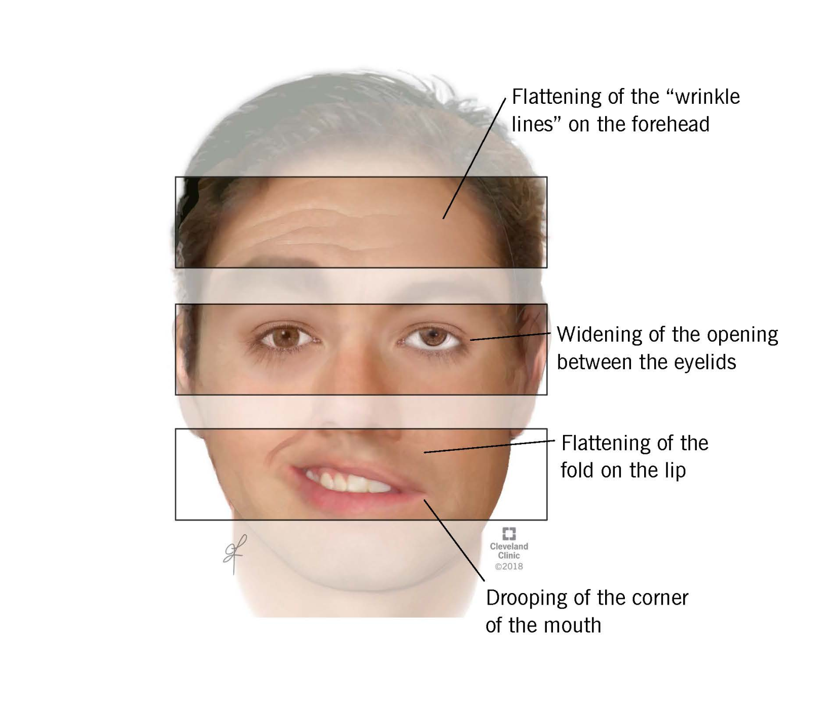 Bell’s Palsy – Exult Diagnostics