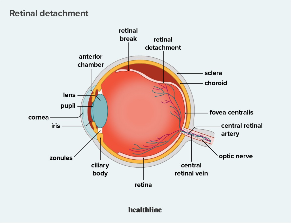 Retinal Detachment – Exult Diagnostics