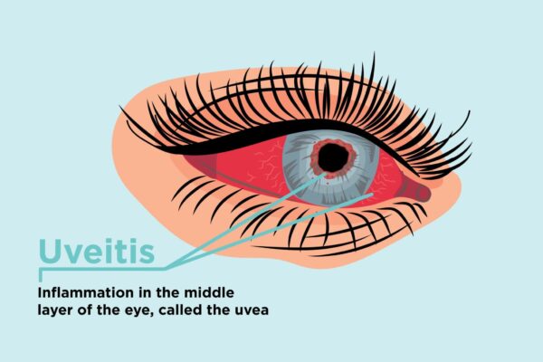 Uveitis – Exult Diagnostics