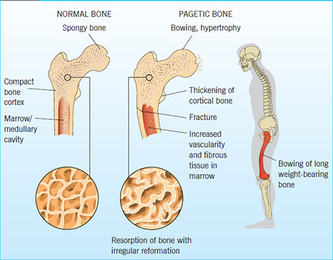 Paget Disease Of Bone – Exult Diagnostics